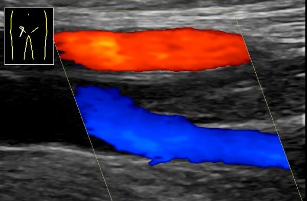 DVT ultrasound - WikEM