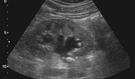 Urolithiasis - WikEM