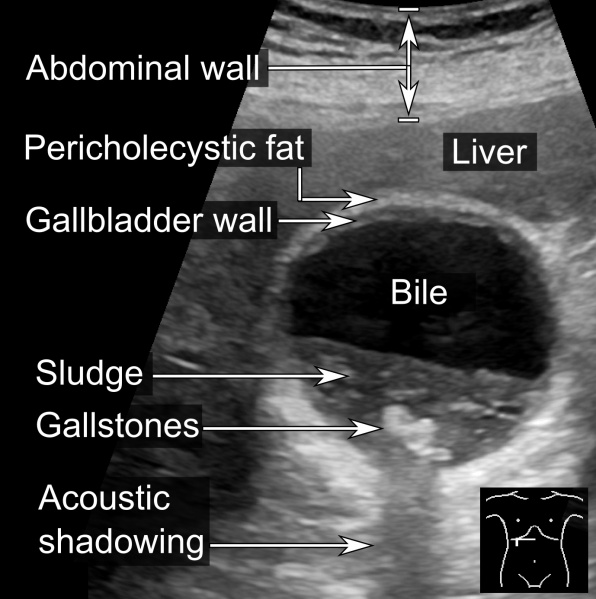File:Ultrasonography of sludge and gallstones, annotated.jpg - WikEM