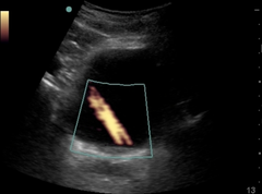 Bladder ultrasound - WikEM