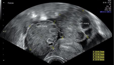 Ovarian hyperstimulation syndrome - WikEM