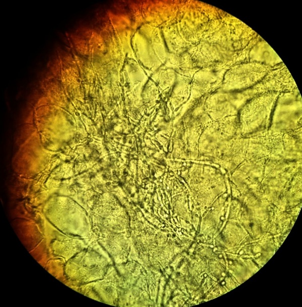 Candida vulvovaginitis - WikEM