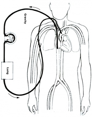 Extracorporeal membrane oxygenation - WikEM