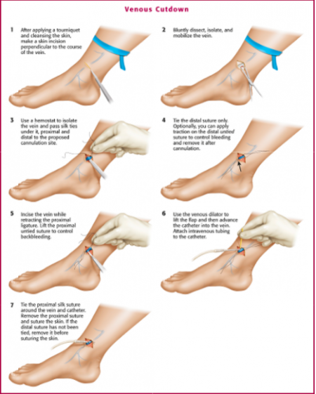 Venous cutdown - WikEM