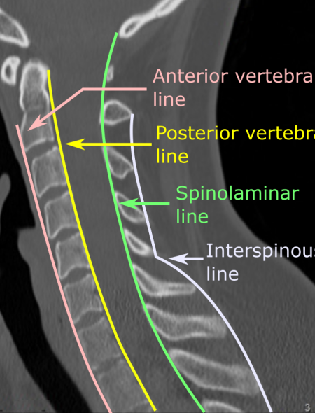 Cervical fractures and dislocations - WikEM