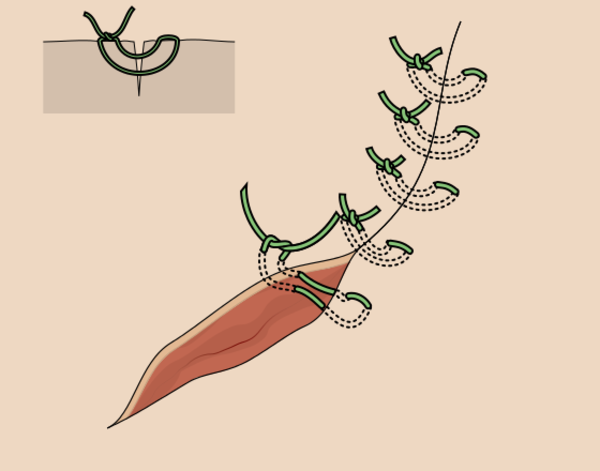 Laceration repair - WikEM