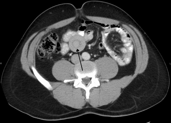 Intussusception - WikEM