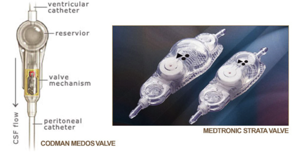 Ventriculoperitoneal shunt complications - WikEM