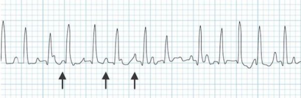 Wandering atrial pacemaker - WikEM