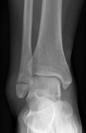 Distal leg fractures - WikEM
