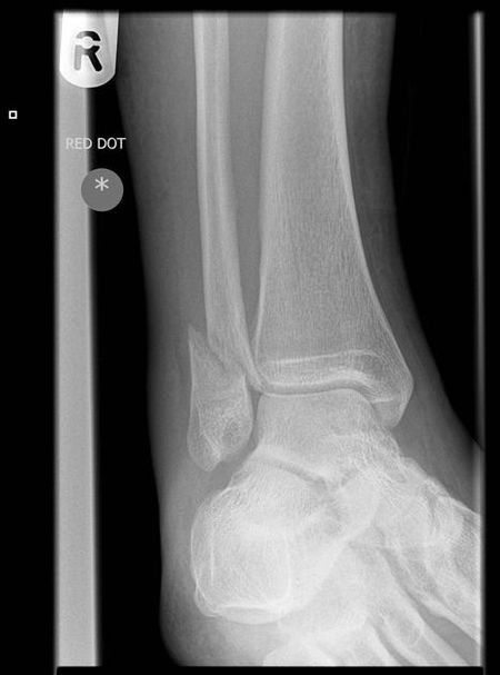 Ankle fracture - WikEM