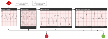Rhythm diagnosis in regular wide complex tachycardia - WikEM