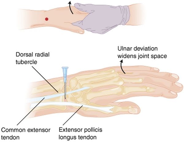 Arthrocentesis: wrist - WikEM