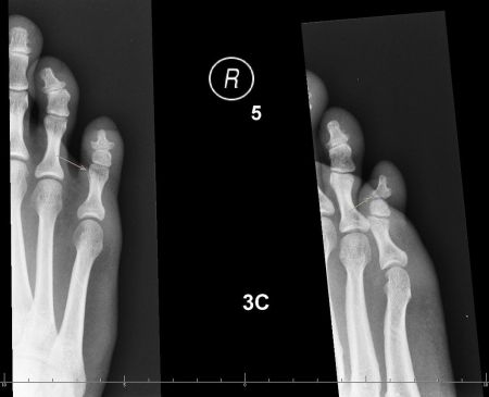 Toe fracture - WikEM