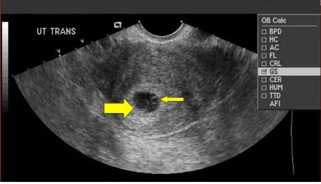 Ultrasound: Pelvic - WikEM
